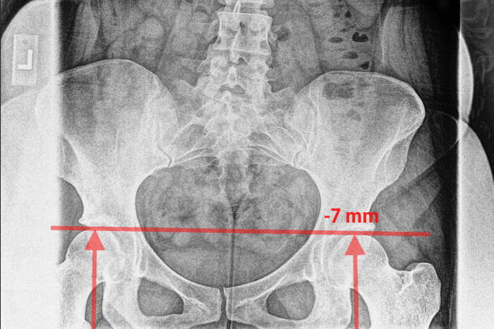 Low Back Pain Caused by Short Leg
